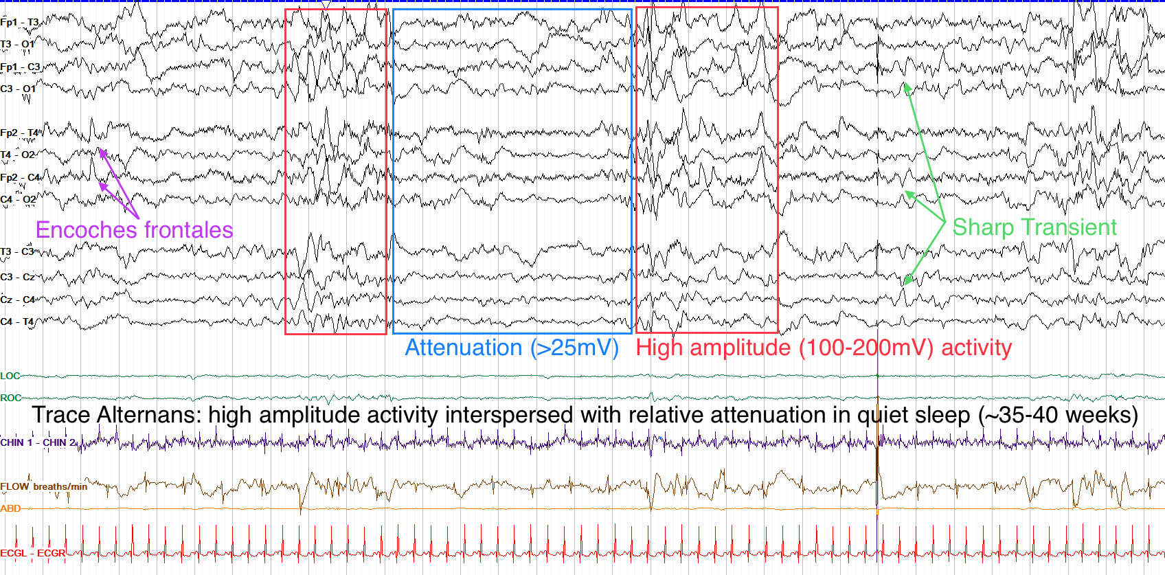 Normal Eeg Tracing